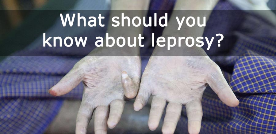 What should you know about leprosy? - Bansal Hospital