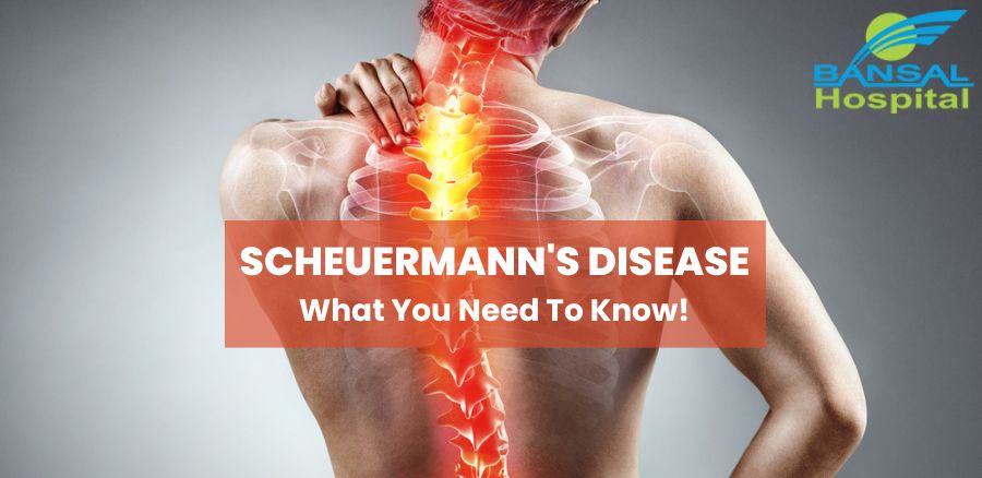 Scheuermann's Disease: What You Need To Know! Bansal Hospital